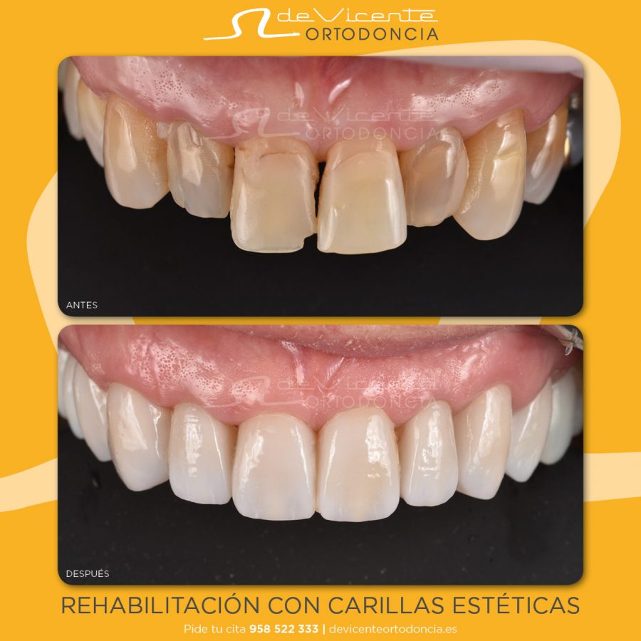 Carillas dentales en Granada - De Vicente Dental. Odontología Avanzada ...